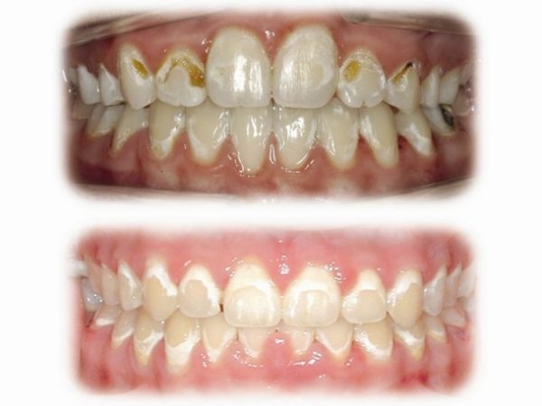 Caries | Higiene durante la ortodoncia | Clínica 'C'O'ped' Mallorca ...